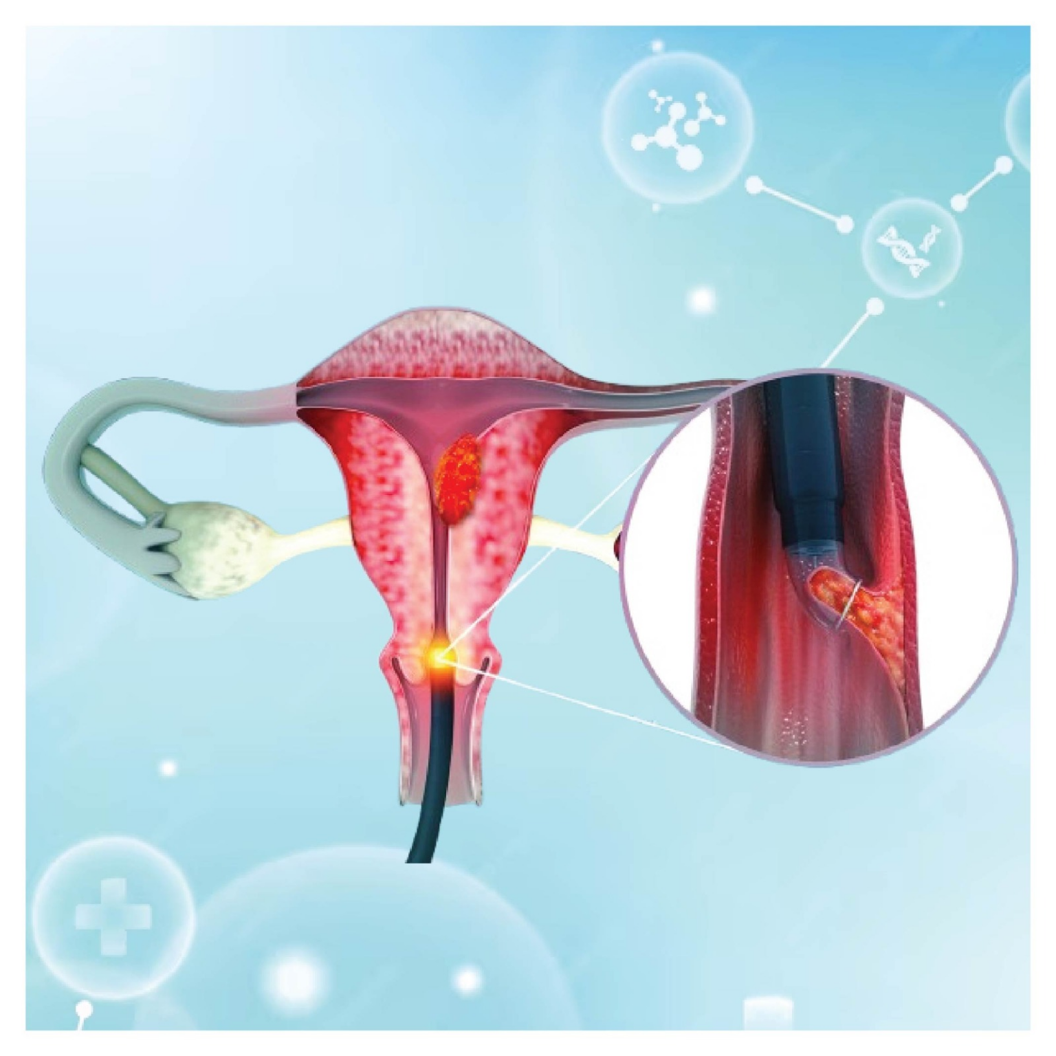 Endometrial Curettage - Dr Lubna Yasmin